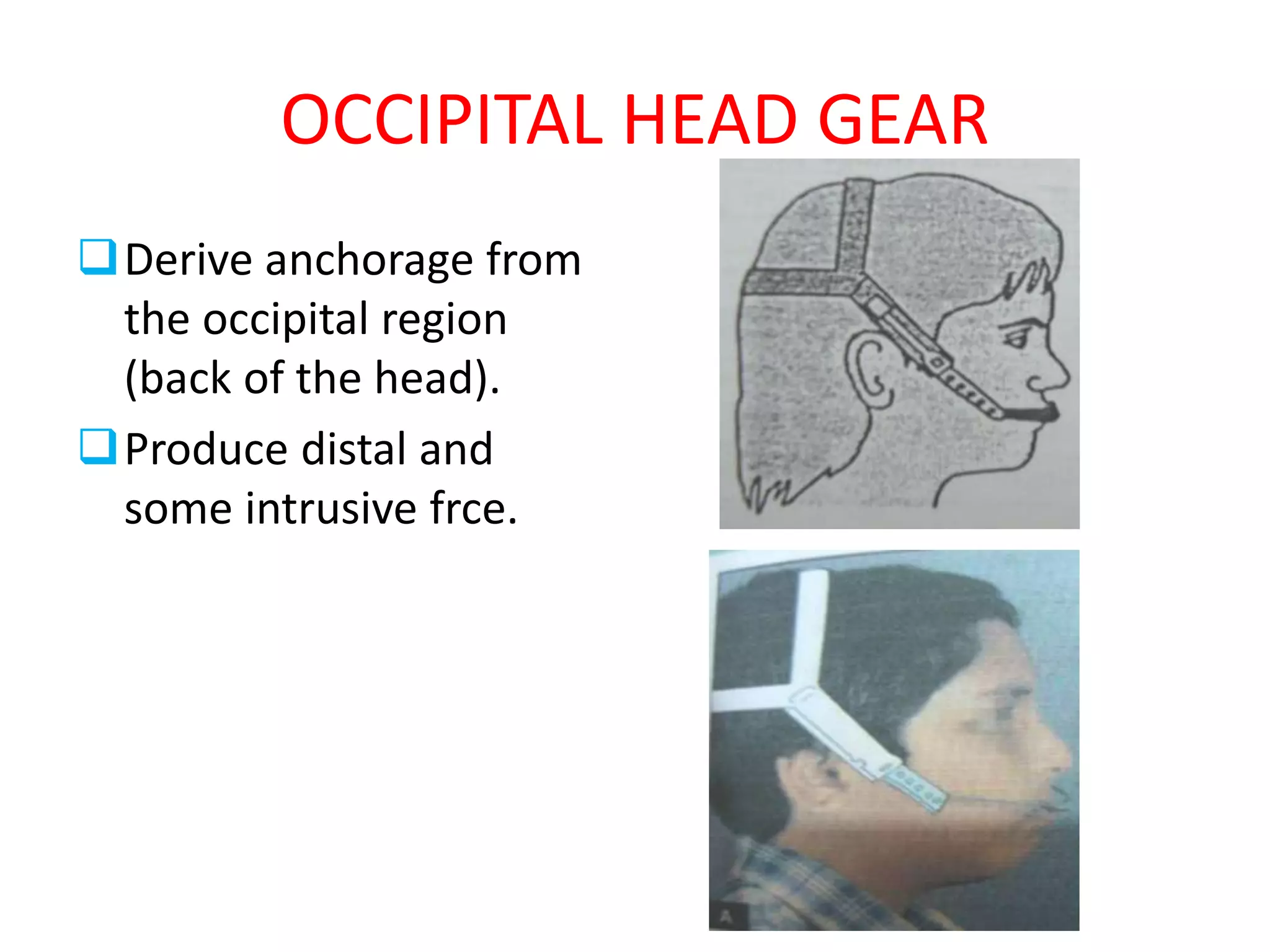 Head gear in orthodontics | PPTX