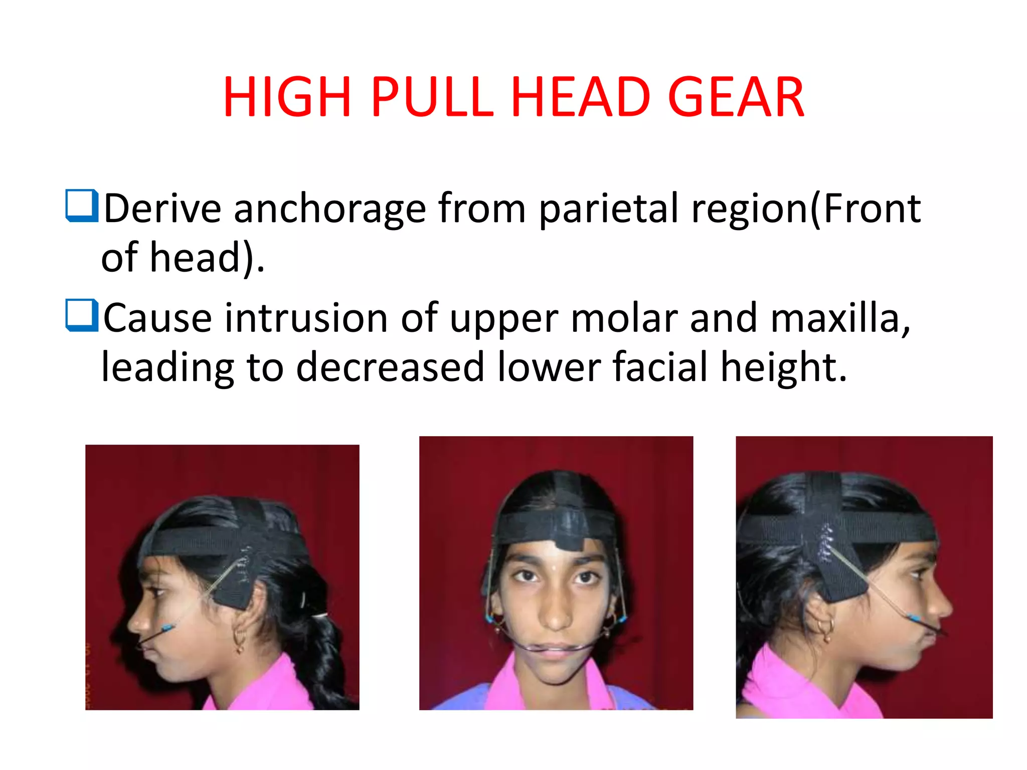 Head gear in orthodontics | PPTX