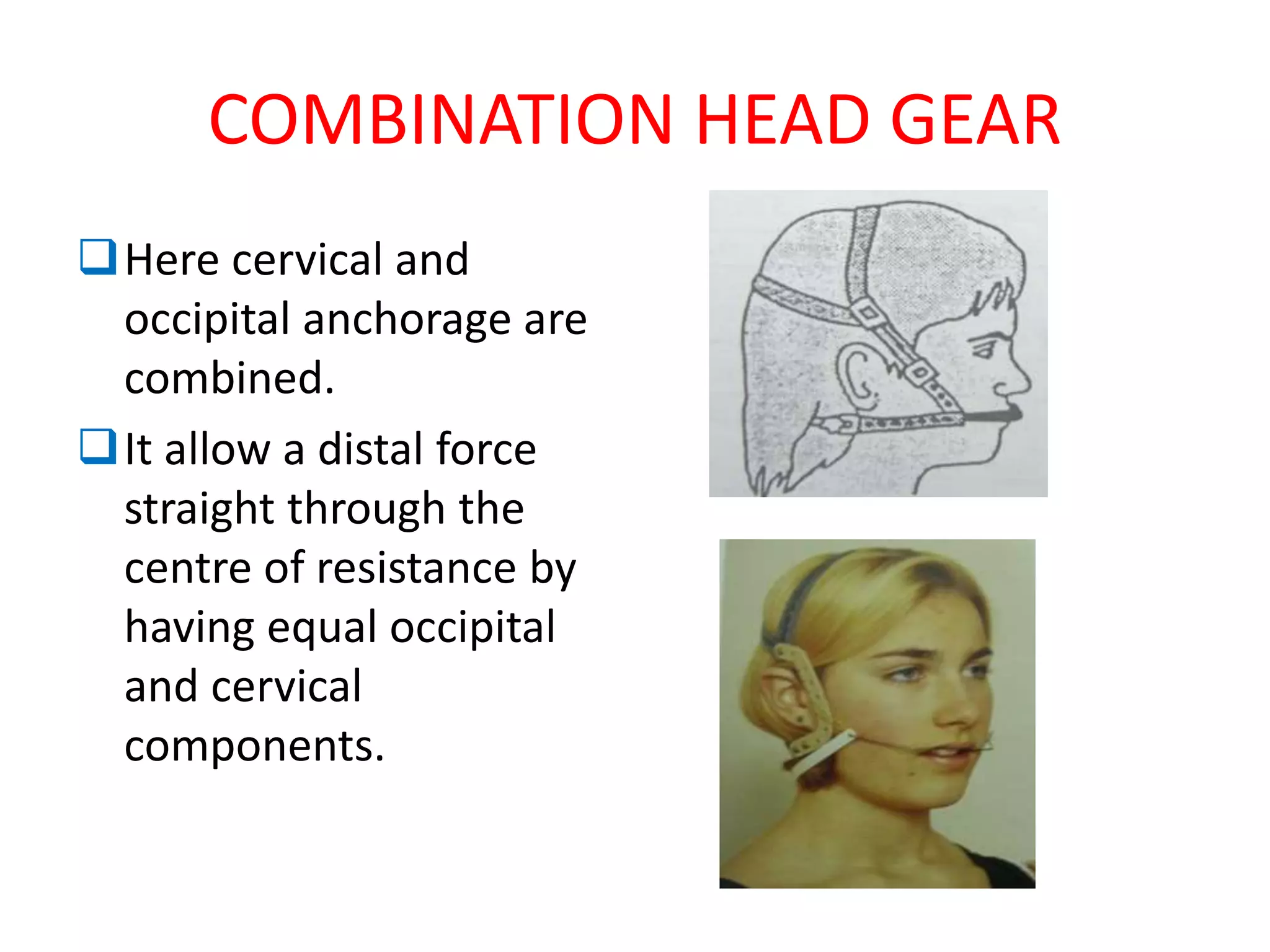 Head gear in orthodontics | PPTX