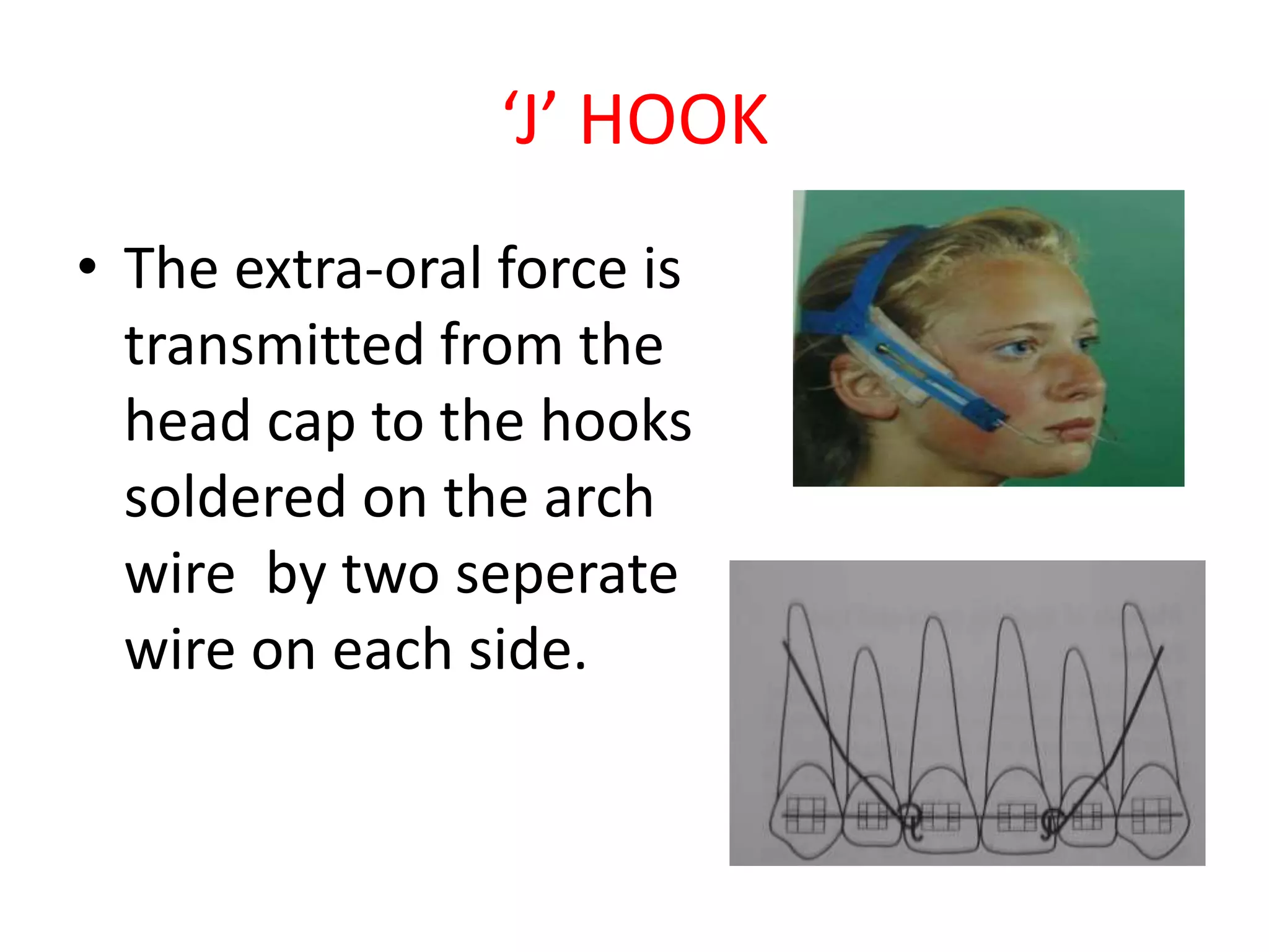 Head gear in orthodontics | PPTX