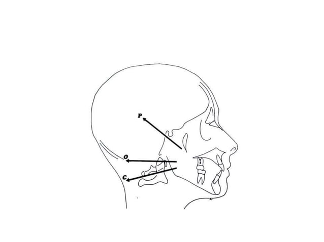 Head gear in orthodontics | PPTX | Oral care | Personal Care