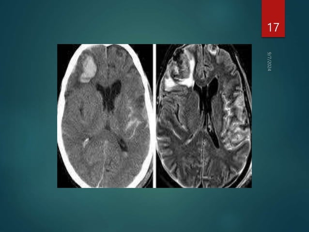 Approach to Head Injuiry, Intracranial Pressure Measurement and ...