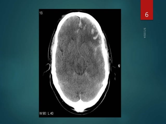 Approach to Head Injuiry, Intracranial Pressure Measurement and ...