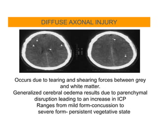Traumatic brain Injury | PPT