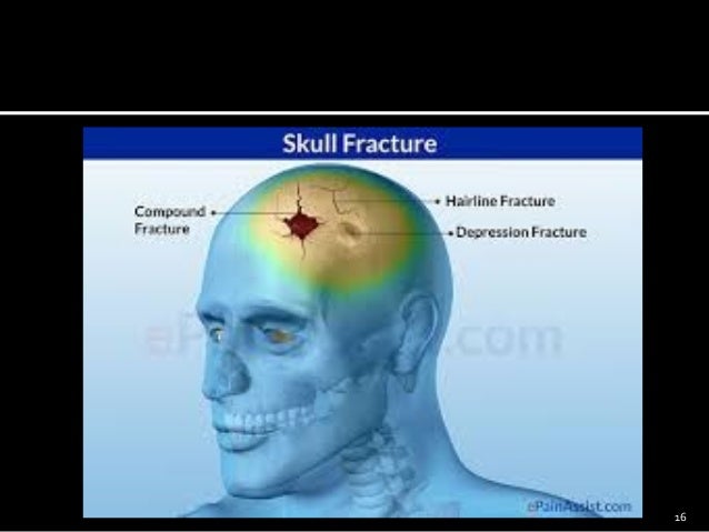 Comminuted Skull Fracture