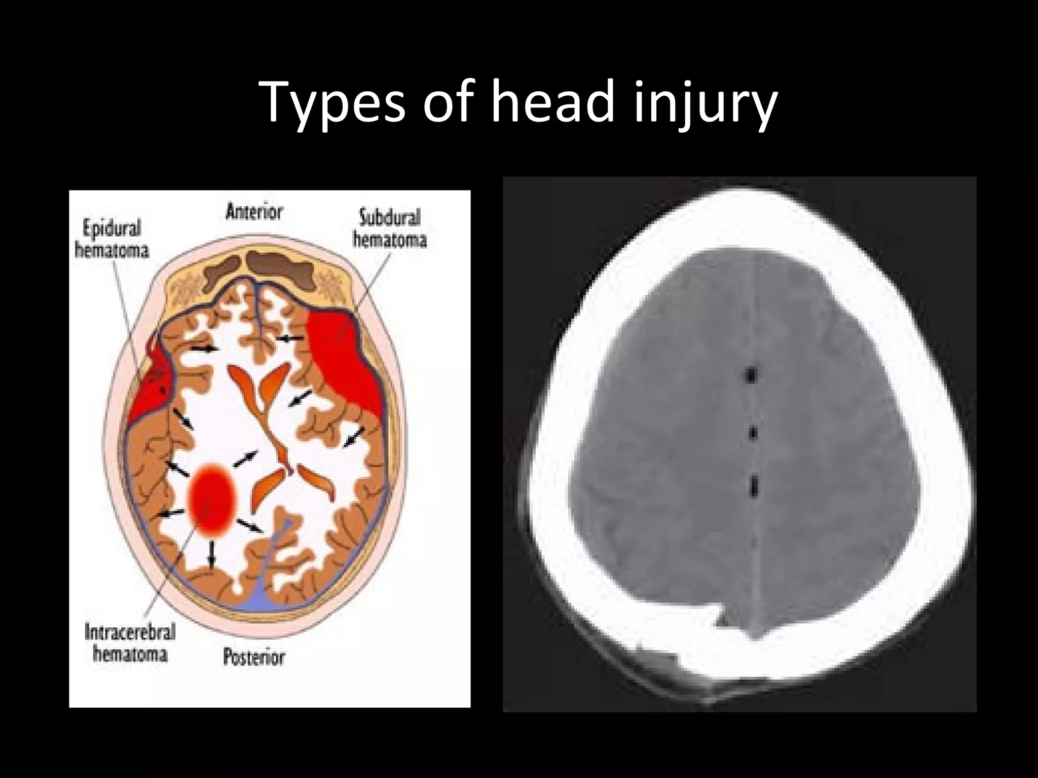 Head injury | PPT