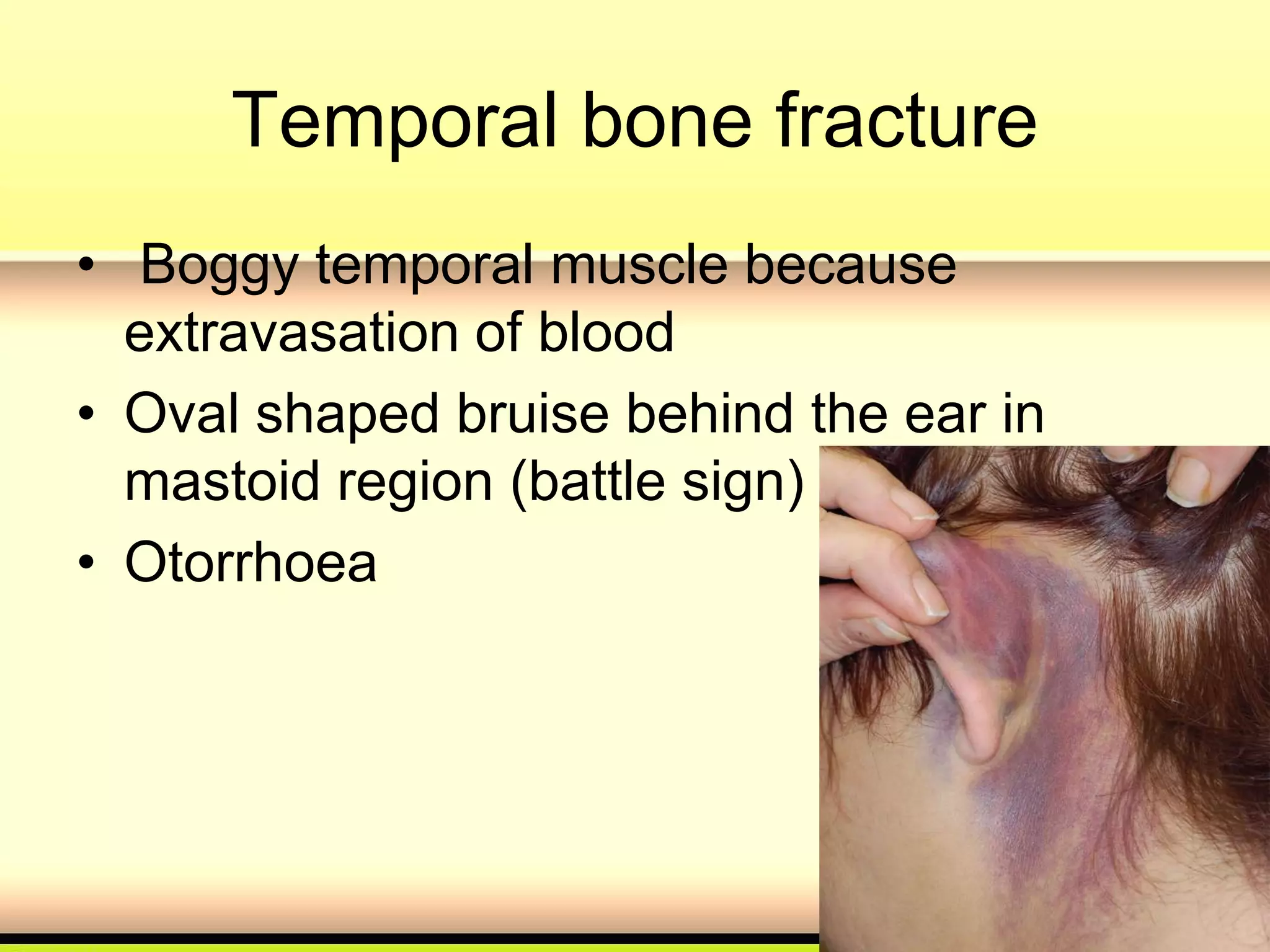 Head injury.ppt