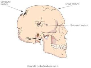 Compound Skull Fracture