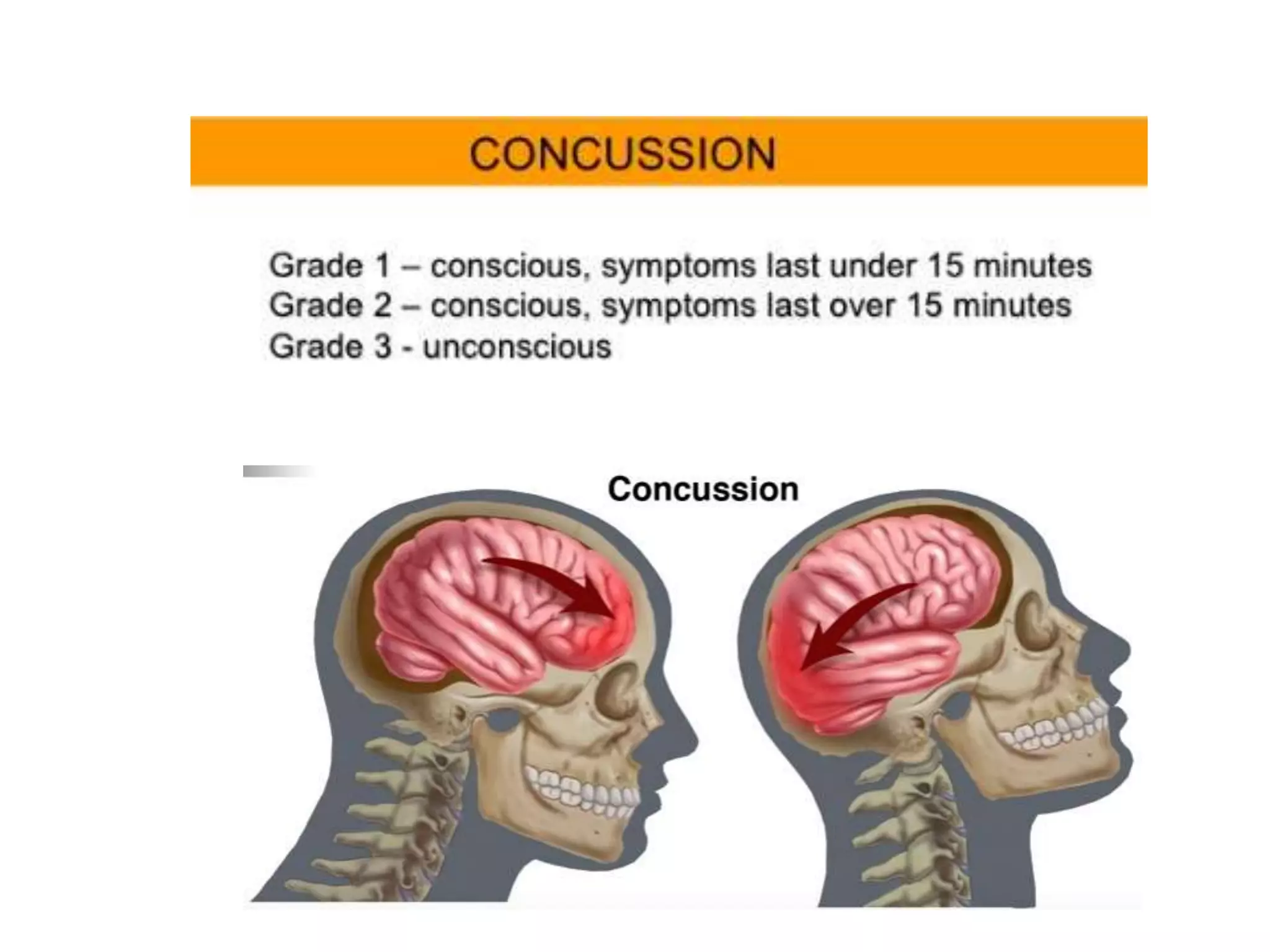 Head injury( Diagnosis/symptoms/investigation/Treatment) | PPTX