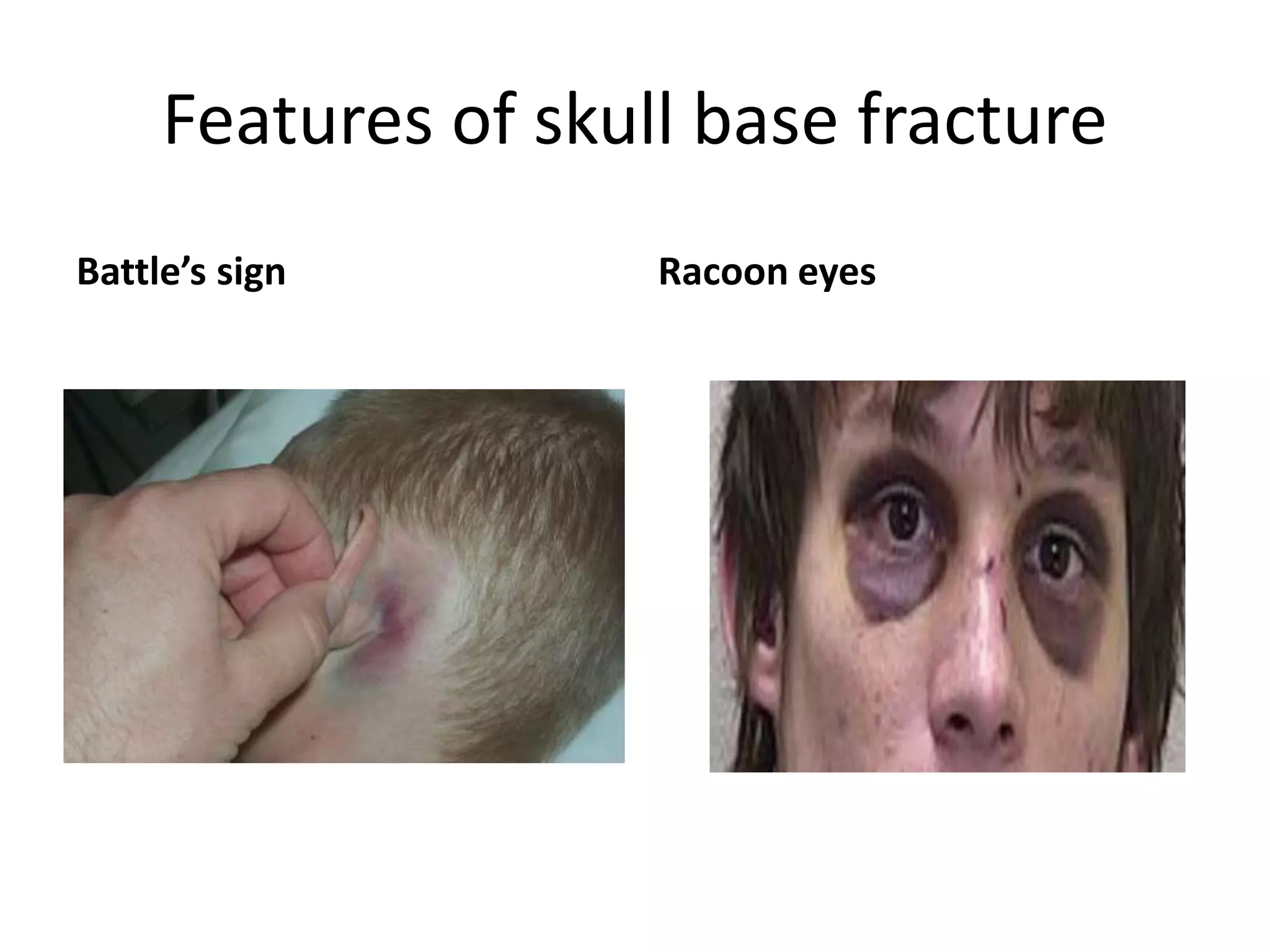 Head injury( Diagnosis/symptoms/investigation/Treatment) | PPTX