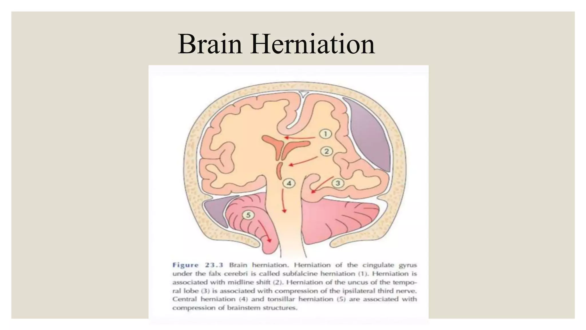 Primary and secondary head injury EDH and SDH | PPTX