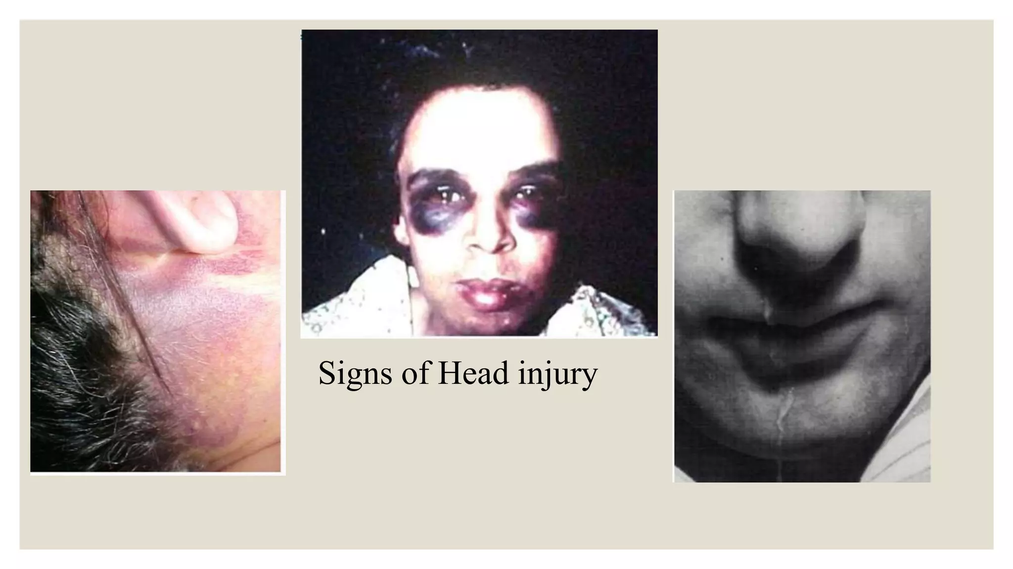 Primary and secondary head injury EDH and SDH | PPTX