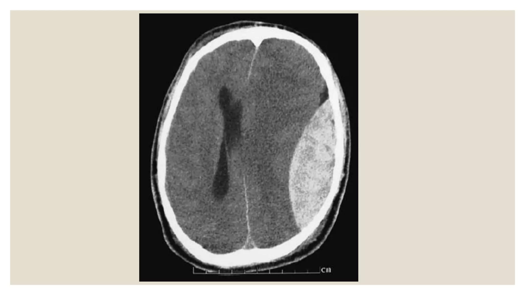 Primary and secondary head injury EDH and SDH | PPTX