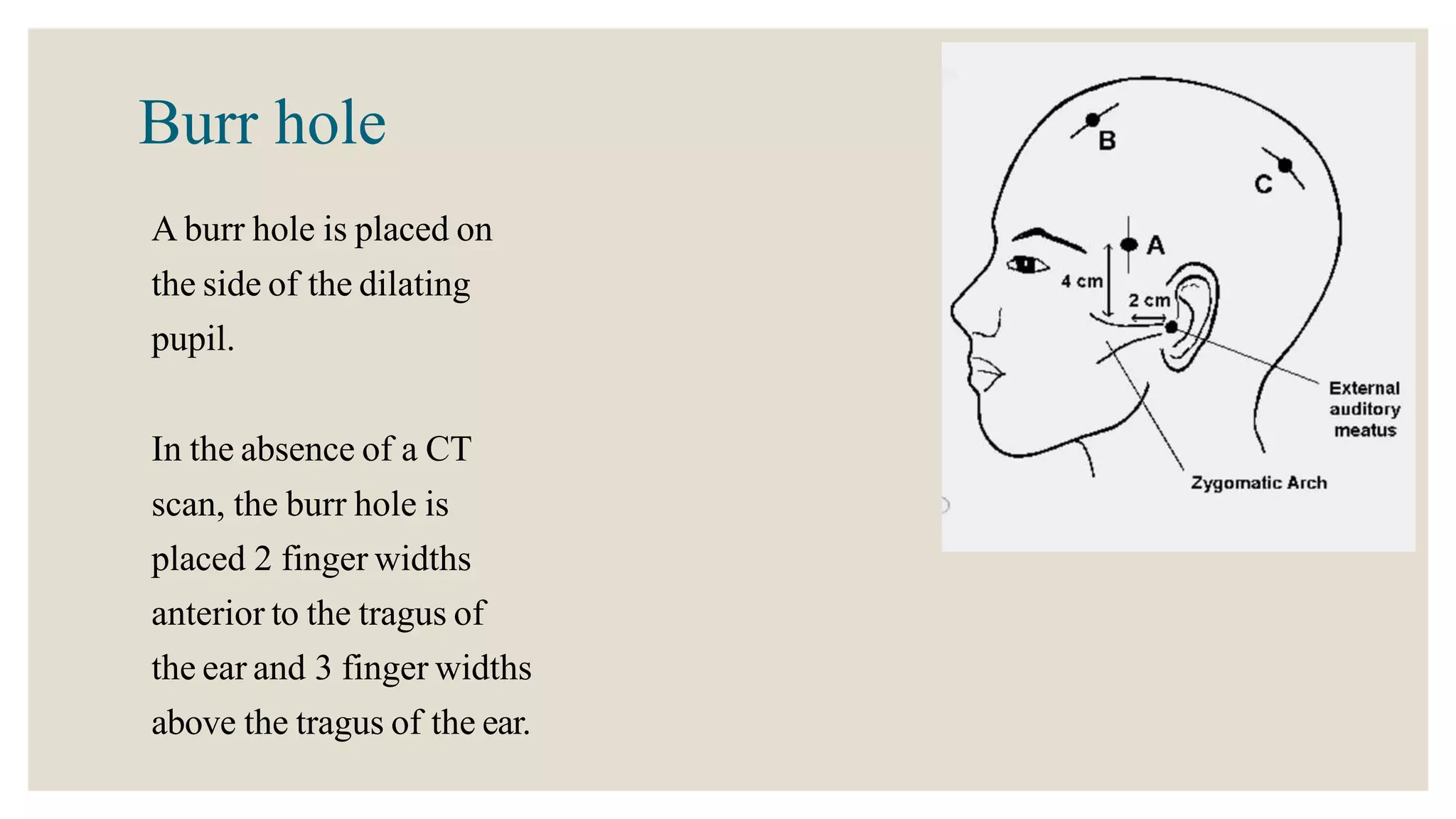 Primary and secondary head injury EDH and SDH | PPTX