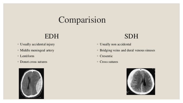Primary and secondary head injury EDH and SDH