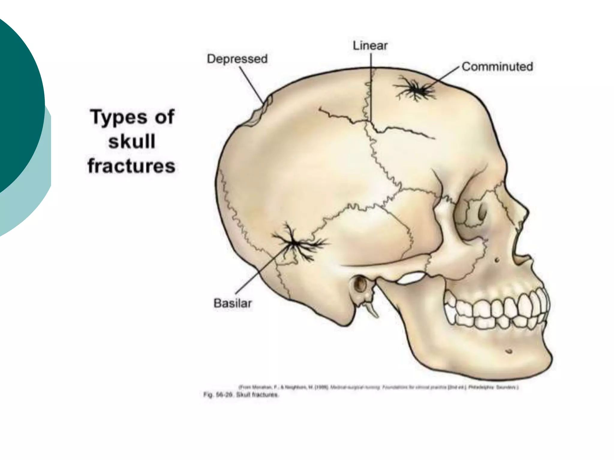 Head injury | PPTX