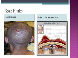 Head injury med surg presentation | PPTX