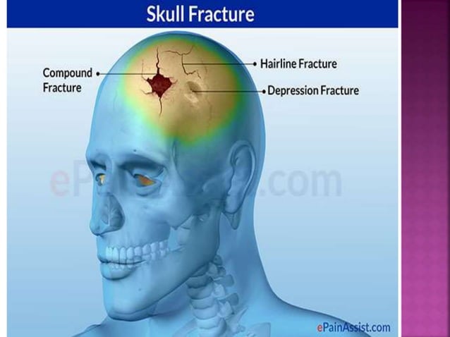 Head injury med surg presentation | PPTX | Death, Injury, or Military ...
