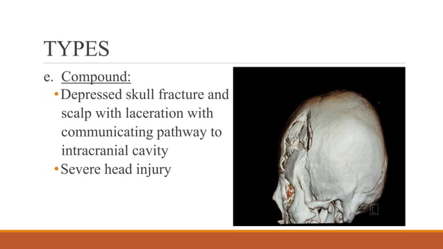 Head injury.pptx | First Aid | Injuries