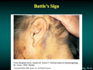 Head Injury.ppt