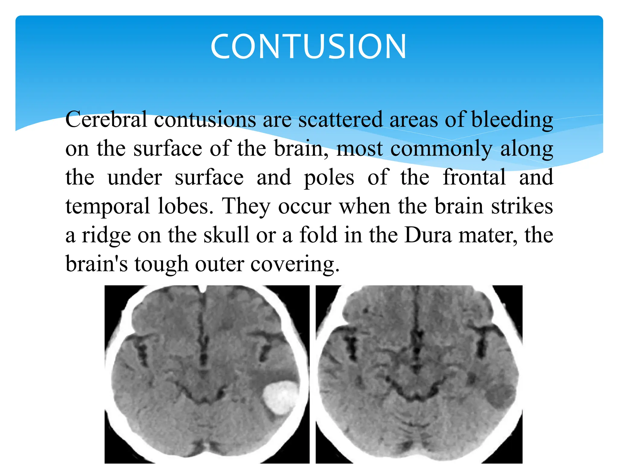 head injury accidental injury RTA .pptx