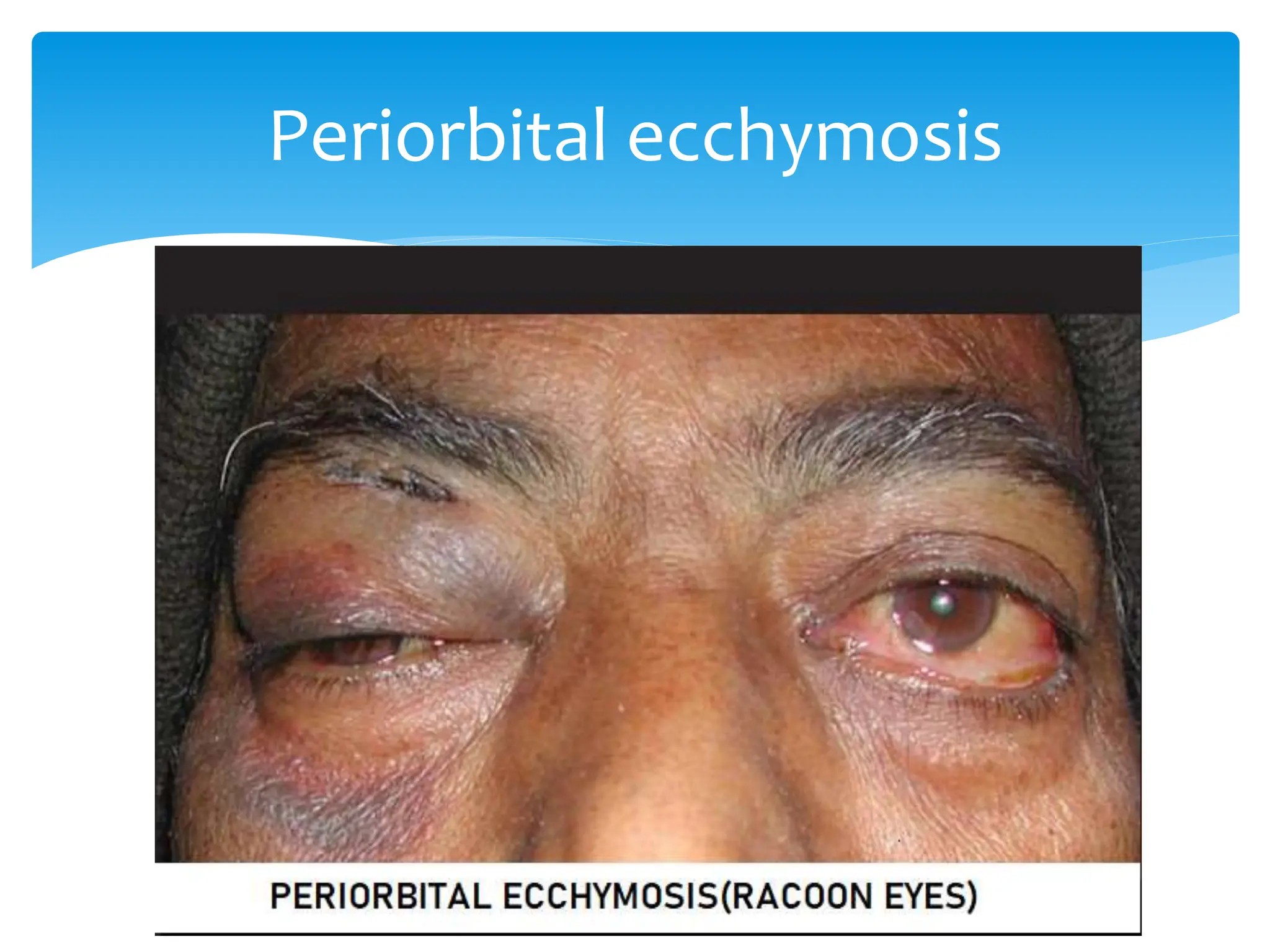 head injury accidental injury RTA .pptx