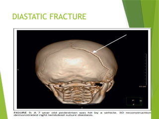 Introduction to head trauma; review of anatomy , hemorrhages | PPT