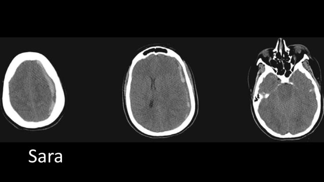Head injury - a hard nut to crack | PPT