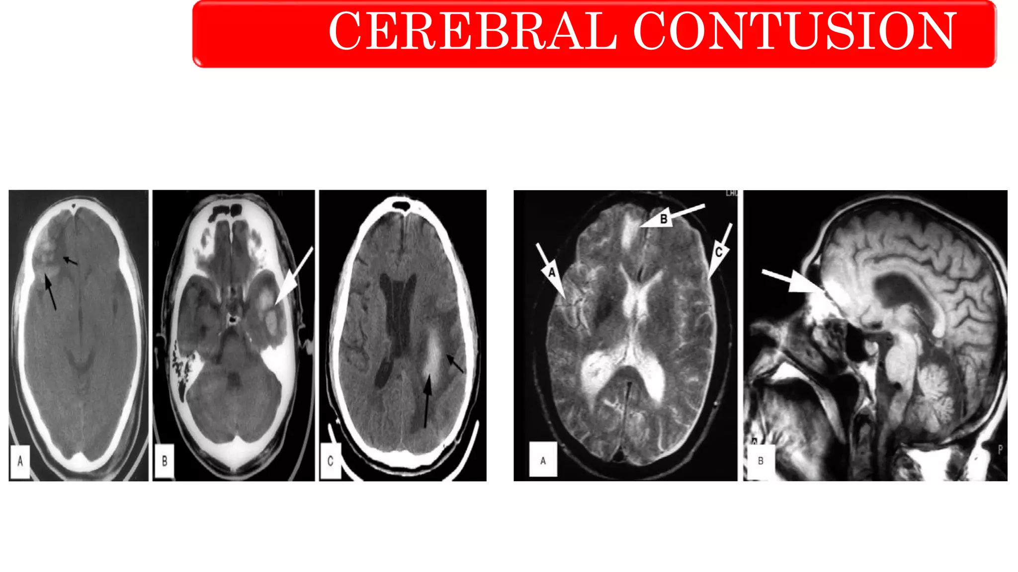 HEAD INJURY- AN OVERVIEW | PPTX