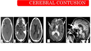 HEAD INJURY- AN OVERVIEW | PPTX