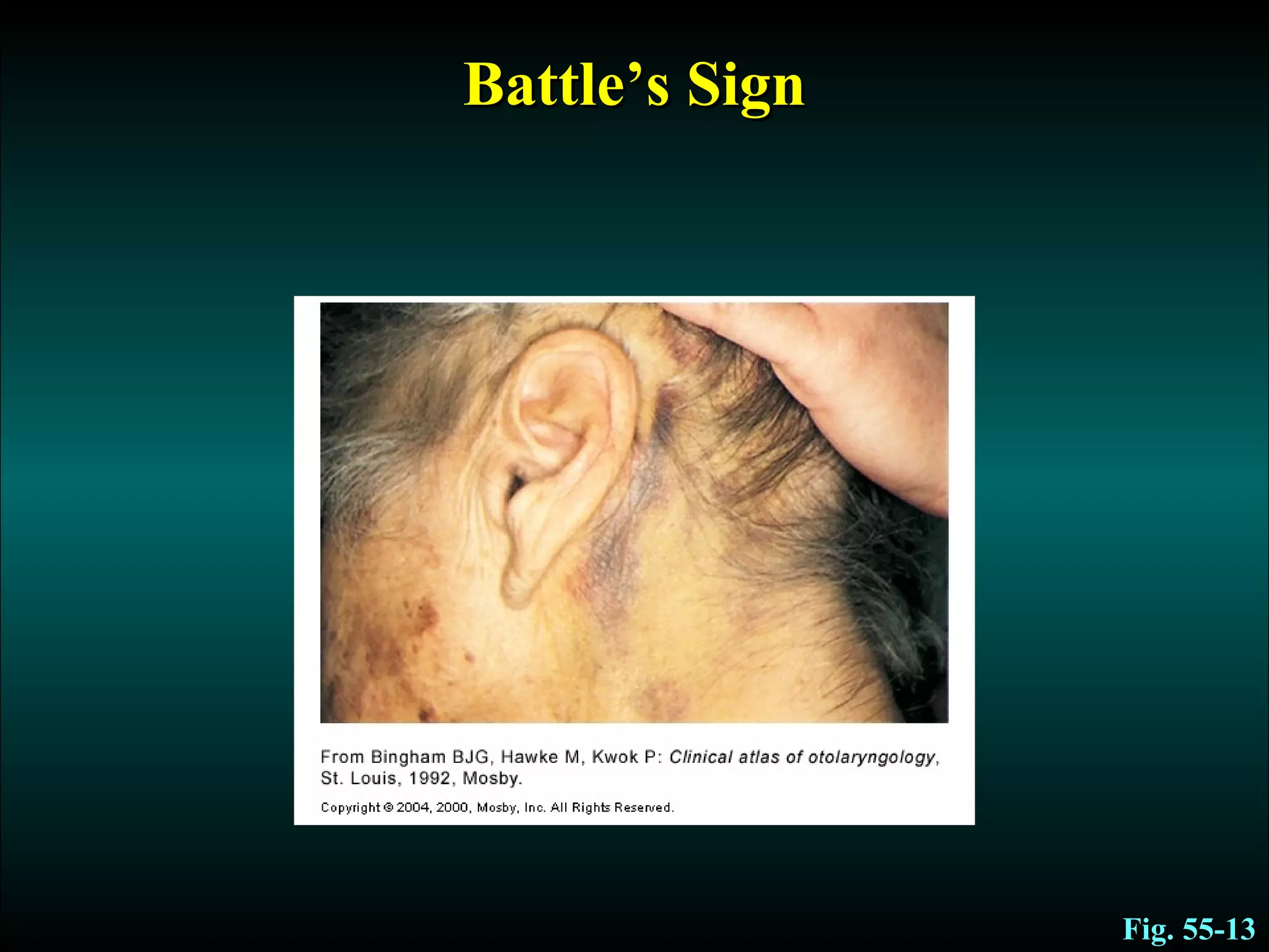 Head injury types, clinical manifestations, diagnosis and management | PPT