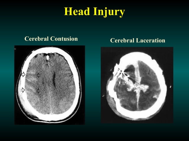 Head injury types, clinical manifestations, diagnosis and management ...