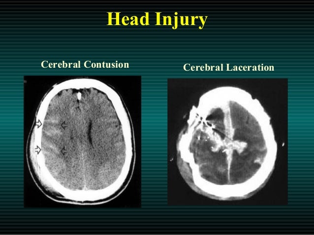 Head injury types, clinical manifestations, diagnosis and management