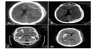 head injury according to ATLS BY DR MUMTAZ ALI.pptx