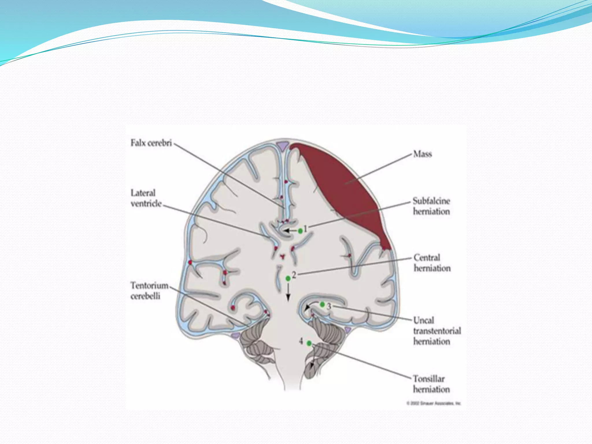 Head injury classification & grading | PPT