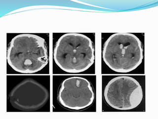 Head injury classification & grading | PPT