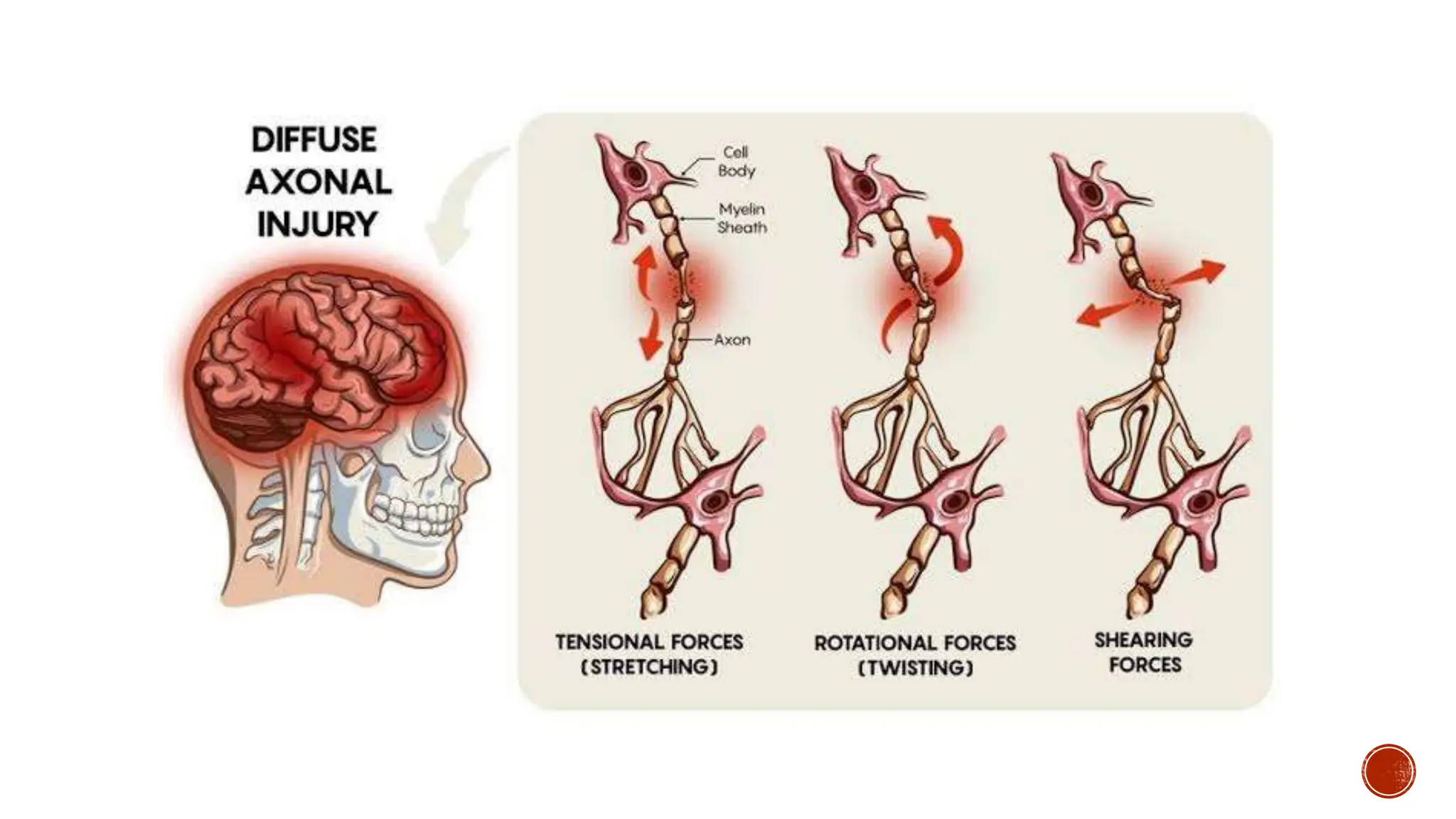 Head Injury (Traumatic Brain Injury) - types, complications and ...