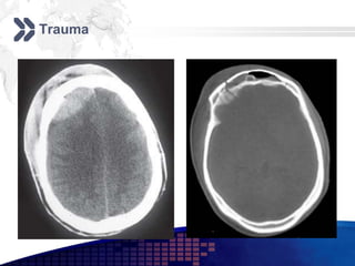 Head injury & head ct | PPTX