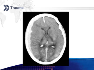 Head injury & head ct | PPTX