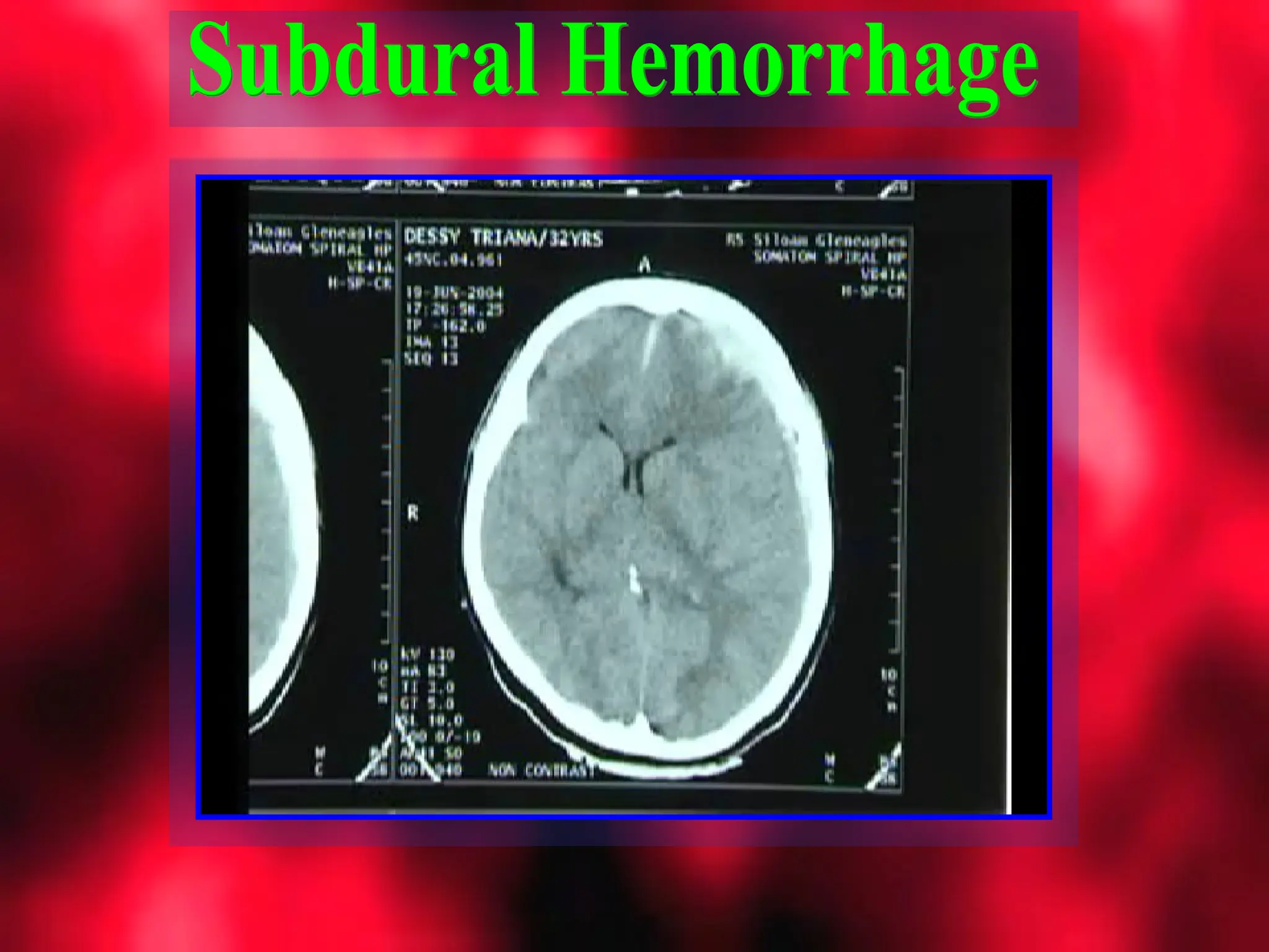 materi kuliah HEAD INJURY bagna bedah saraf.ppt