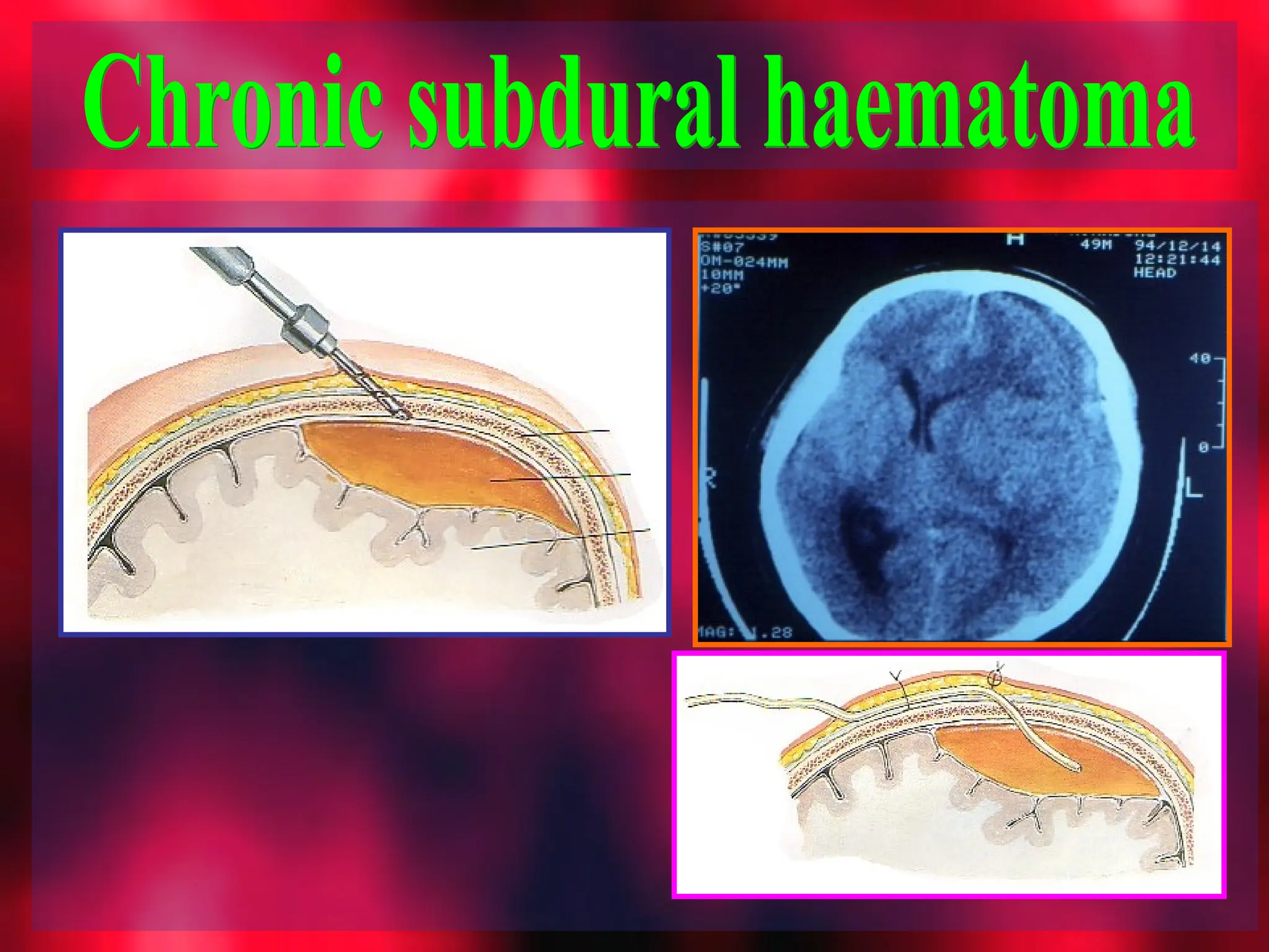 materi kuliah HEAD INJURY bagna bedah saraf.ppt
