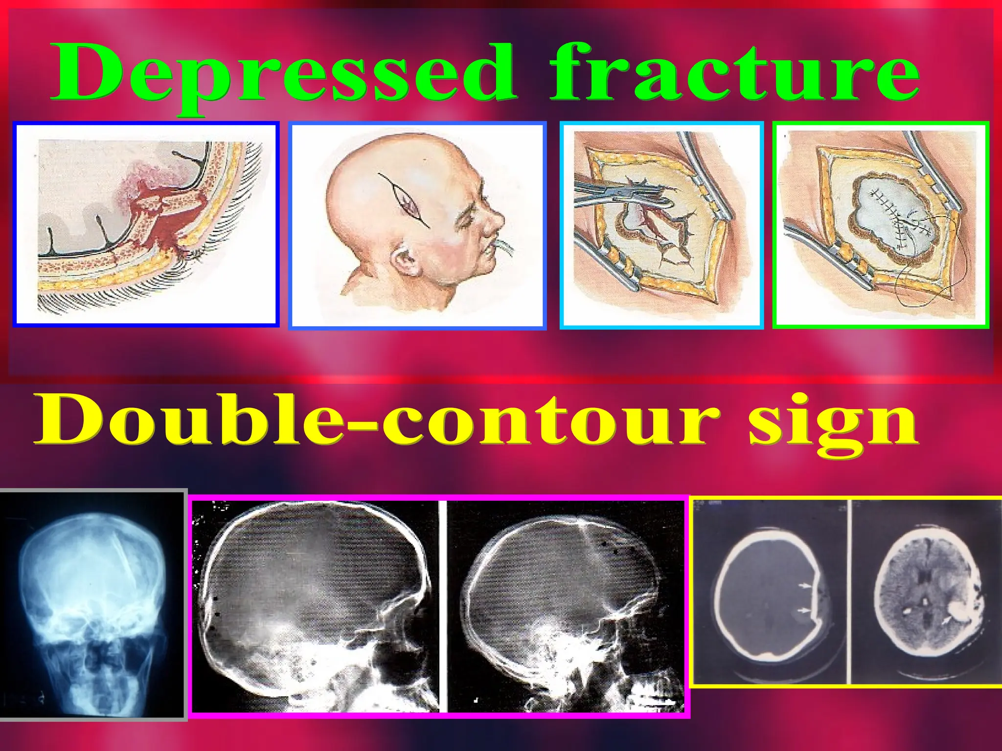 materi kuliah HEAD INJURY bagna bedah saraf.ppt
