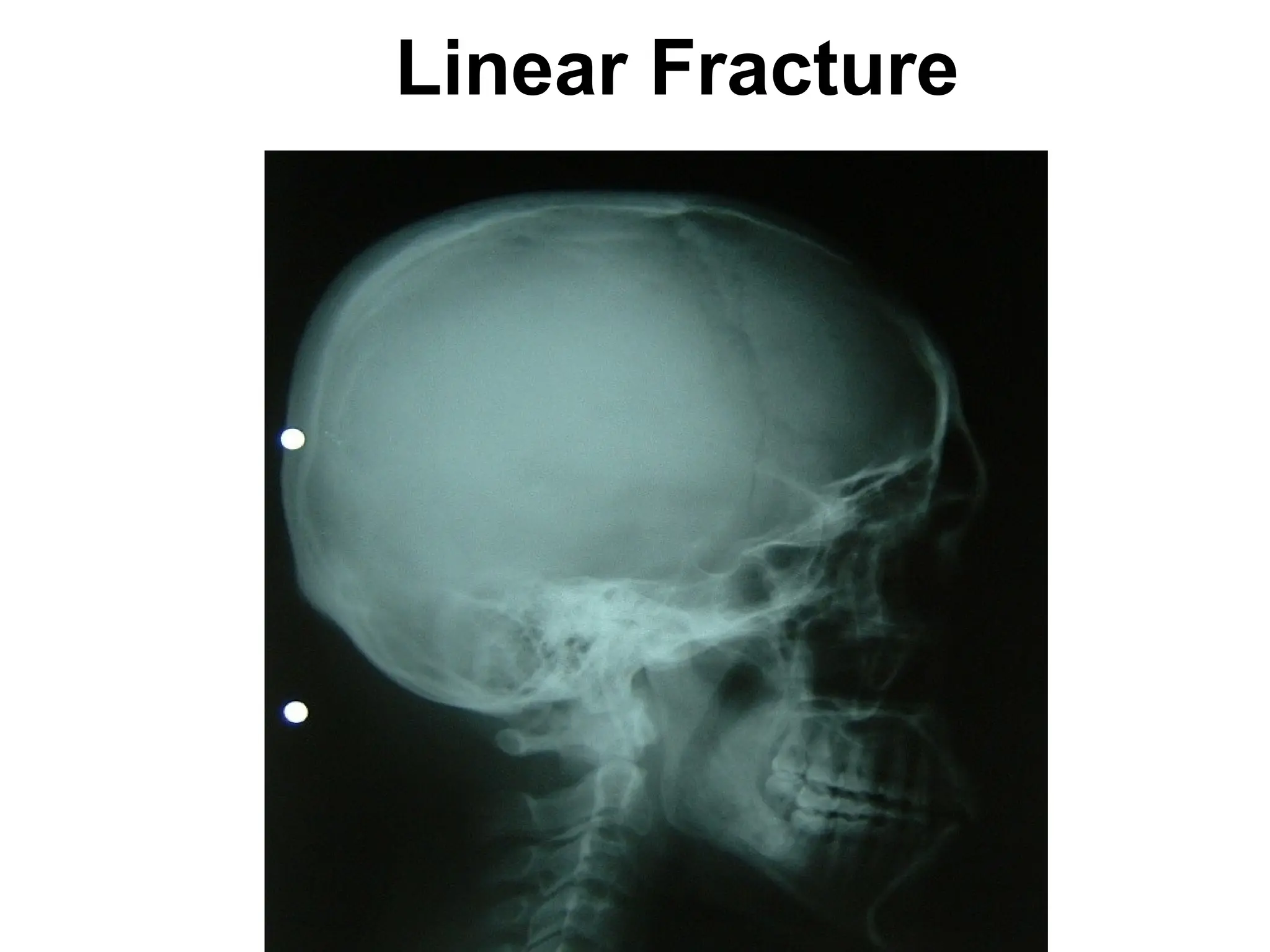materi kuliah HEAD INJURY bagna bedah saraf.ppt