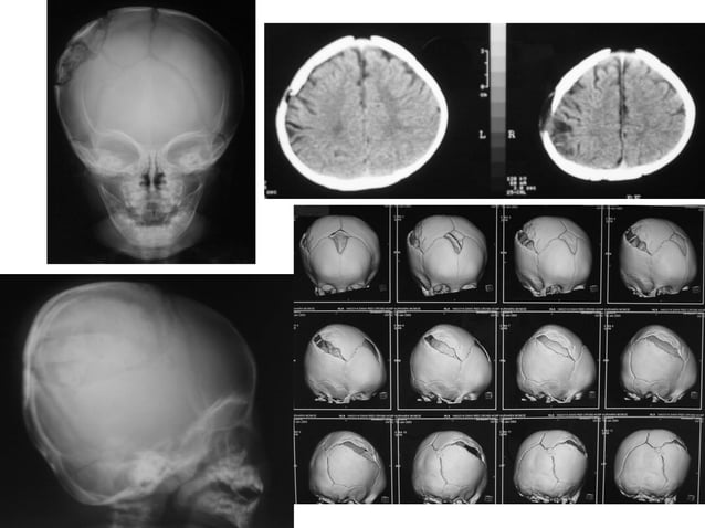 materi kuliah HEAD INJURY bagna bedah saraf.ppt