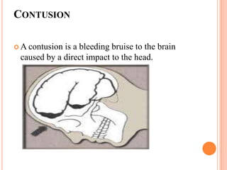 Head injury ppt | PPTX