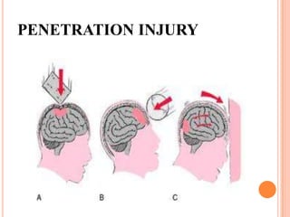 Head injury ppt | PPTX