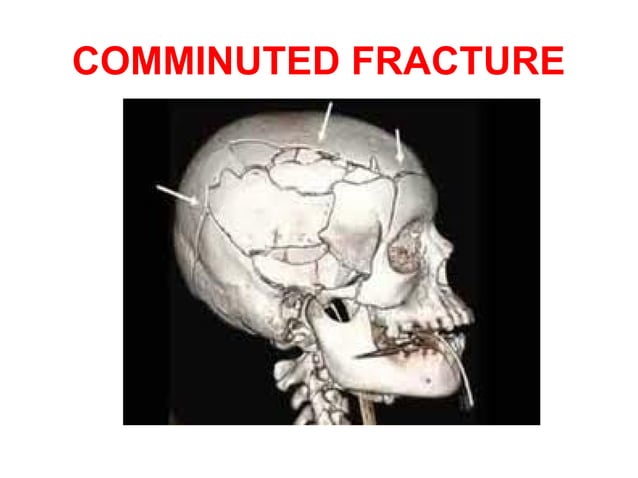 HEAD_INJURYHEAD_INJURYHEAD_INJURYHEAD_INJURY | PPT