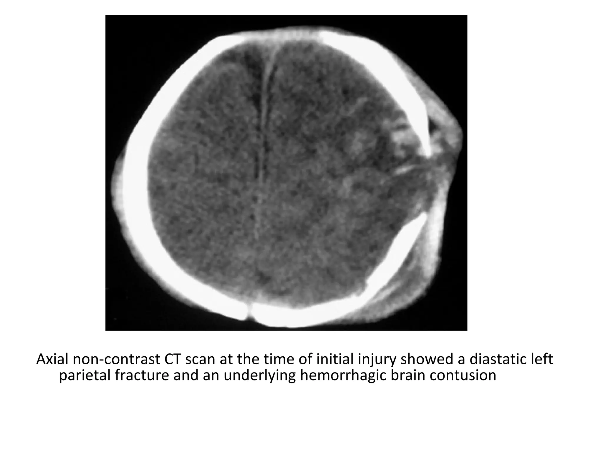 Diagnostic Imaging of Cerebral Trauma | PPT
