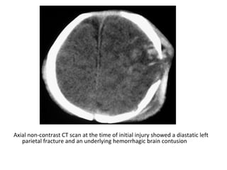 Diagnostic Imaging of Cerebral Trauma | PPT