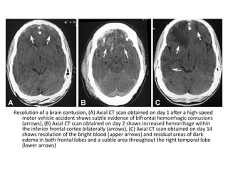 Diagnostic Imaging of Cerebral Trauma | PPT